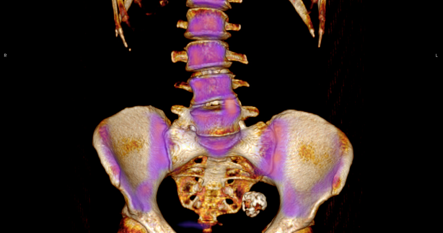 Bone scan patient information leaflet - Nuclear Medicine Blog