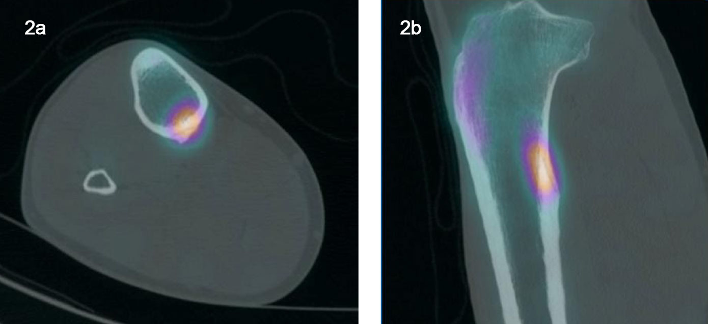 Case of the week: Tibial stress fracture and medial tibial stress ...