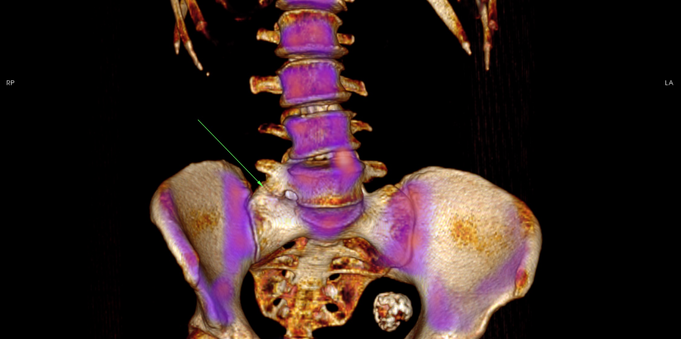 Case of the week: Bone SPECT-CT Lumbosacral Transitional Vertebra ...