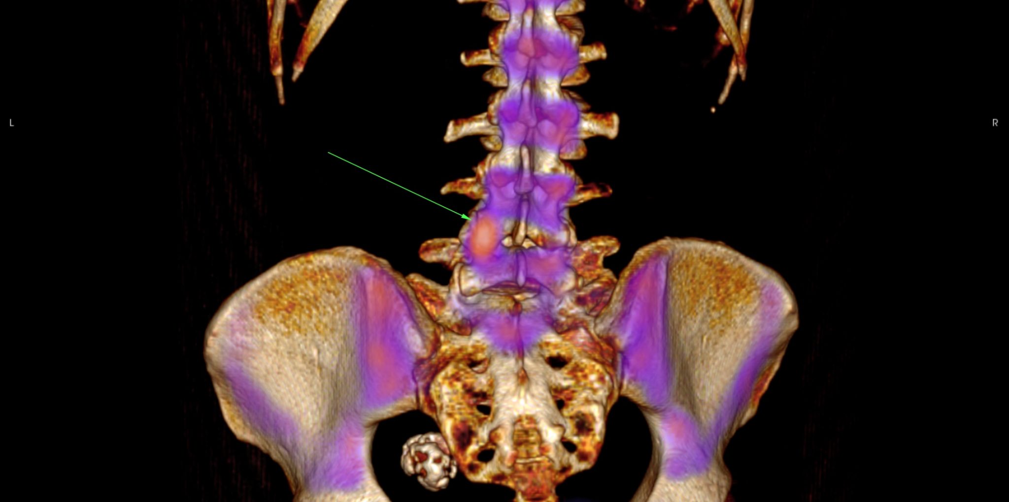Case of the week: Bone SPECT-CT Lumbosacral Transitional Vertebra ...
