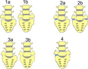 Case of the week: Bone SPECT-CT Lumbosacral Transitional Vertebra ...