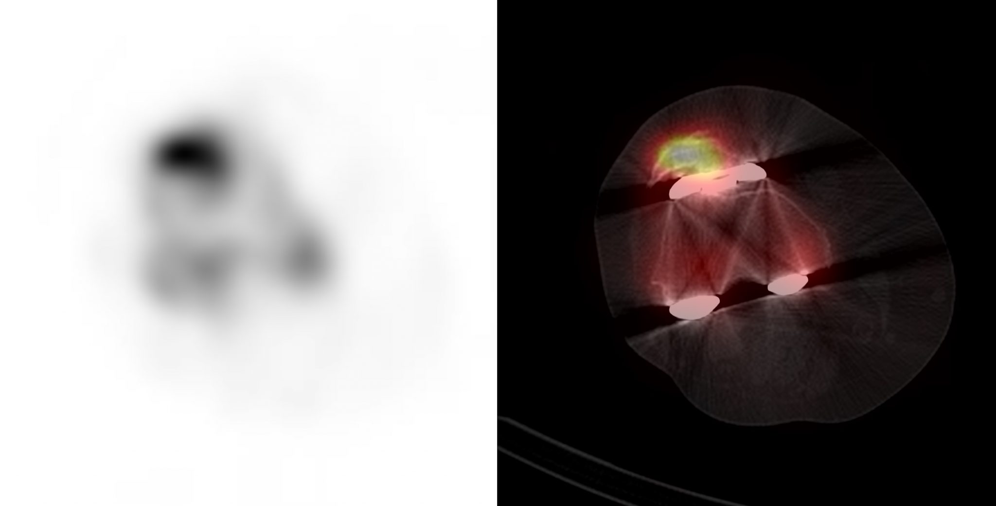 Nuclear Medicine Studies: SPECT-CT of total knee replacements - Nuclear ...
