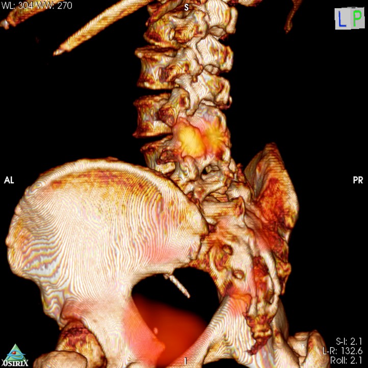 Nuclear Medicine Studies: SPECT-CT of the spine - Nuclear Medicine Blog