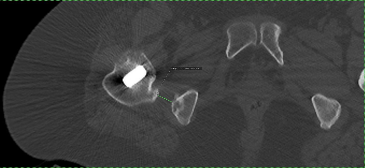 Case of the week: Ischiofemoral impingement following total hip ...