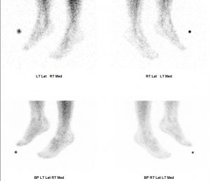 Nuclear Medicine Studies: Blood Pool SPECT-CT - Nuclear Medicine Blog