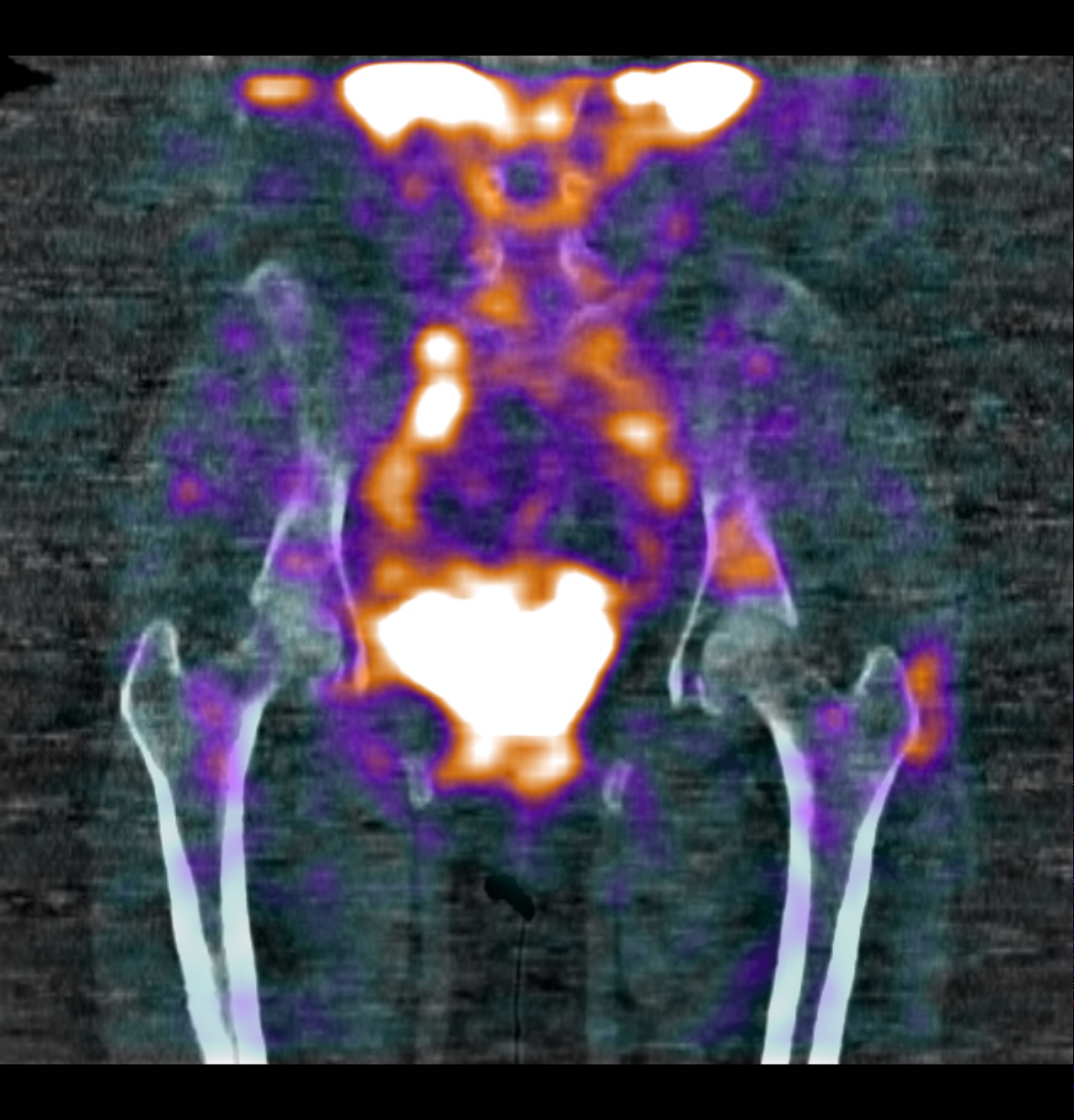 Nuclear Medicine Studies: Blood Pool SPECT-CT - Nuclear Medicine Blog
